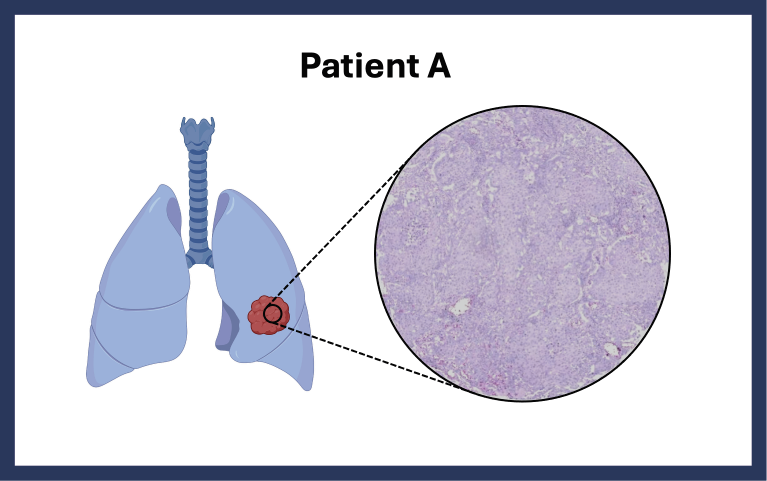AI Improves Lung Cancer Diagnostics